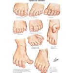 Congenital Toe Deformities