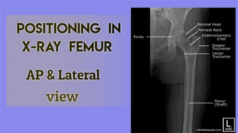 Lateral Femur X Ray Labeled At Arthur Popp Blog