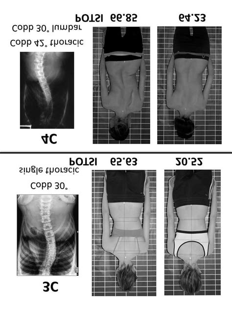 Clinical Cases 3c Scoliotic Curve With 30 • Cobb Angle And Improvement Download Scientific