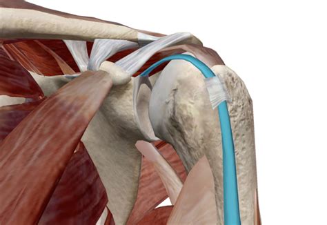 Shoulder Biceps Tenodesis Surgery Hss Shoulder Specialist Surgeon In Nyc And Nj — Michael Fu