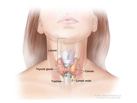 Fusion Genes Linked To Metastasis After Thyroid Cancer Nci