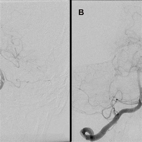 Digital Subtraction Angiography A Before Thrombectomy Shows Right Download Scientific Diagram