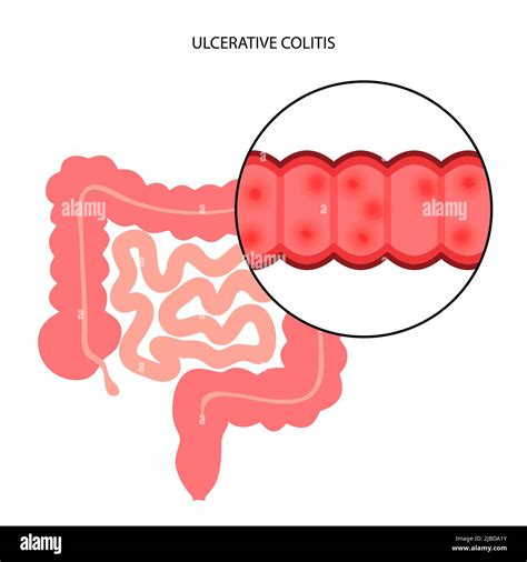 Ulcerative Colitis Illustration Stock Photo Alamy