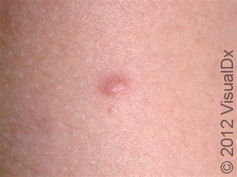 Dermatofibroma Treatment Dermatofibroma By Science Photo Library