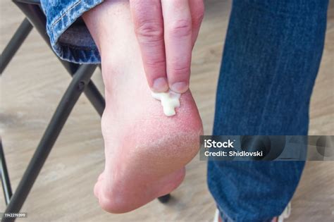 남자는 발 또는 아 킬 레 스 건 피부에 보습과 약물 또는 크림 연 고를 않습니다 항 염증 제 연 고 또는 보습 건조 피부 발 뒤꿈치와 발바닥을 사용 하 여 통증 완화 및