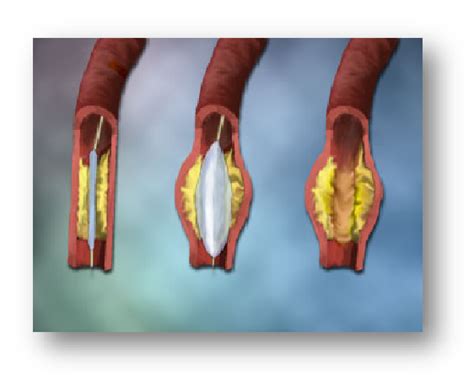 Ptca Percutaneous Transluminal Coronary Angioplasty Patient