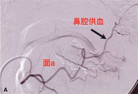 脑血管解剖学习笔记第19期：面动脉颈部走行和分支 脑医汇