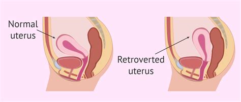 Definition Of Retroverted Uterus