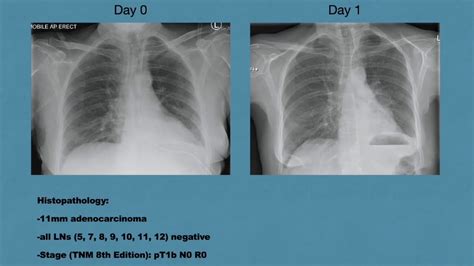 Robotic Left Lower Lobe Split Lateral S9 And Posterior S10 Basal Bisegmentectomy Youtube