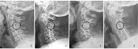 Exploring Radiographic Patterns Of The Cervical Spine Including Zygapophyseal Joints In Axial