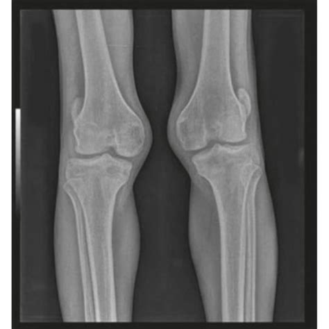 Comparison Of The Effect Of Roberts Edge Detection Algorithm On The Download Scientific