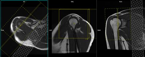 Shoulder Mri Planning Mri Shoulder Protocols Indications For Mri Shoulder Scan