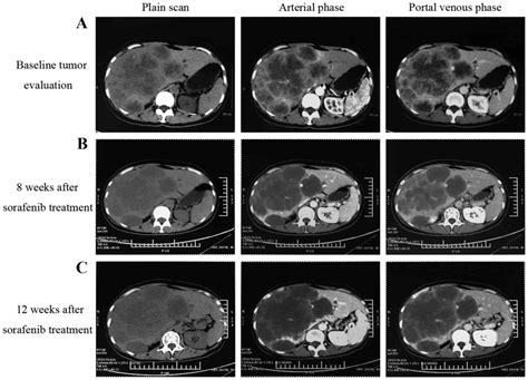 A Single Center Experience Of Sorafenib Monotherapy In Patients With Advanced Intrahepatic