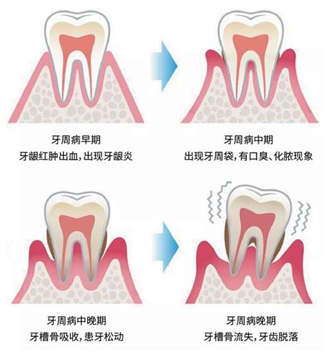 牙周病的搜索结果 百度图片搜索