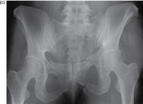 Severe Pelvic Trauma Anesthesia Key