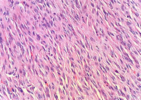 Histopathology Image Hand × 400 Showing Predominant Spindle Shaped Download Scientific Diagram