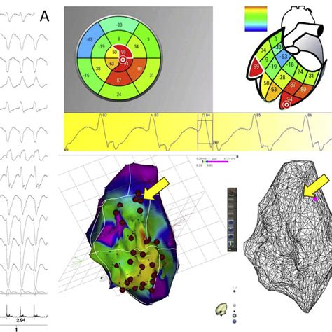 Pdf Real Time Localization Of Ventricular Tachycardia Origin From The 12 Lead Electrocardiogram