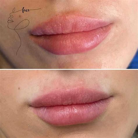 5 Effective Alternatives To Lip Fillers In 2023