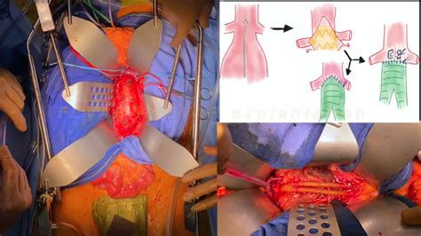 Xavier Berard Auf Linkedin Fevar In Evar Total Explantation Midline