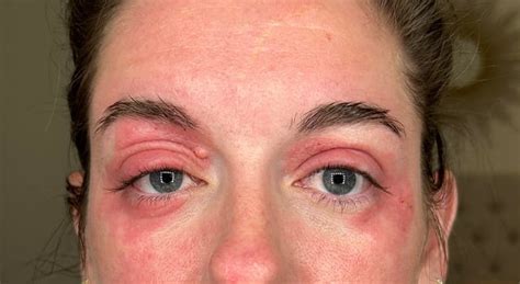 Eye Psoriasis Out Of Control Rpsoriasis