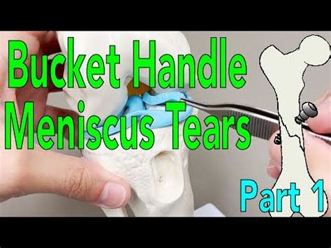 Bucket Handle Meniscus Tears Part 1 Youtube