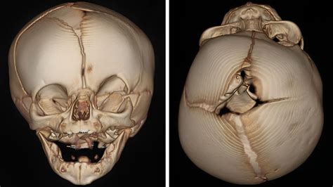 40 Facts About Primary Craniosynostosis