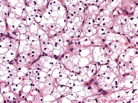 Rcc Histology Clear Cell Kccure