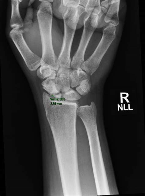 Scaphoid Ununited Proximal Pole 3 The Emergency Physio