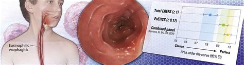 Eosinophilic Esophagitis Endoscopy Findings At Bill Kemp Blog