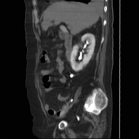 Persistent Nephrogram Sign Heralding Contrast Induced Nephrotoxicity