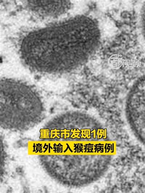 重庆市发现1例境外输入猴痘病例猴痘新冠肺炎新浪新闻