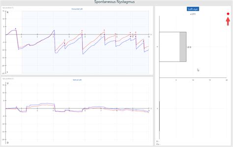 Visualeyes™ Spontaneous Nystagmus Interacoustics