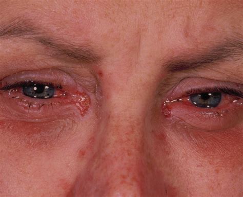 Allergic Conjunctivitis Gp Eyes