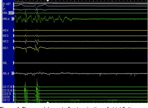 Figure 2 From Sinus Nodal Dysfunction After Left Atrial Flutter Ablation A Preventable
