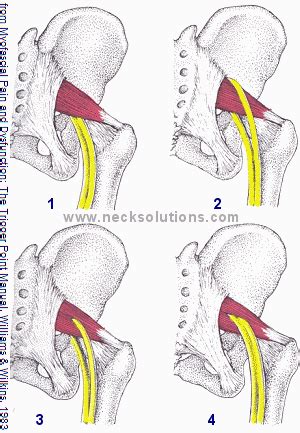 Piriformis Syndrome Symptoms Causes And Treatment