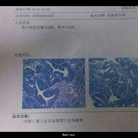 腹腔镜直肠癌根治术一例 医联