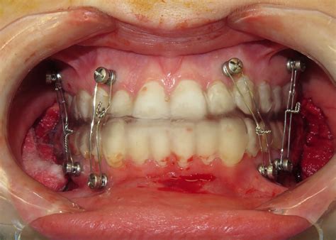 Clear Aligner Orthognathic Splints Caos And Custom Maxillary Fixation