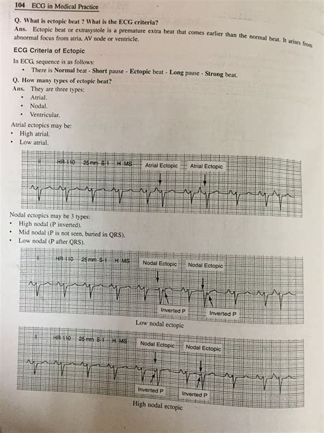 Ecg Atrial And Ventricular Ectopics