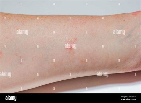 Allergic Skin Rash On The Inner Surface Of The Forearm Psoriasis Atopic Dermatitis Eczema