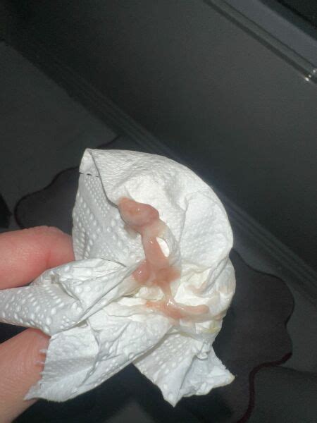 Pink Discharge Photos Included Mumsnet