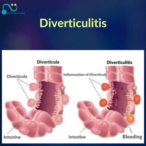 Bleeding From Anus Rectal Bleeding Causes And Treatments Assoc