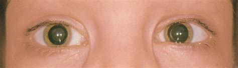 Bilateral Cataracts Symptoms Diagnosis And Treatments