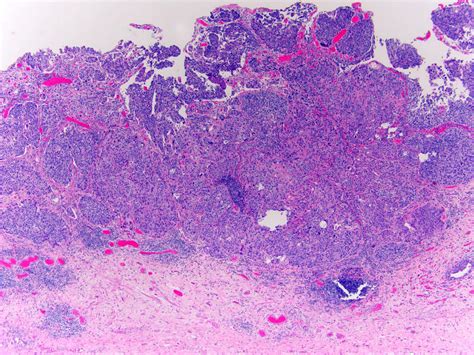 Pathology Outlines Invasive Urothelial Carcinoma