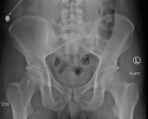 Hip Dislocation Pre And Post Reduction Xr Jetem