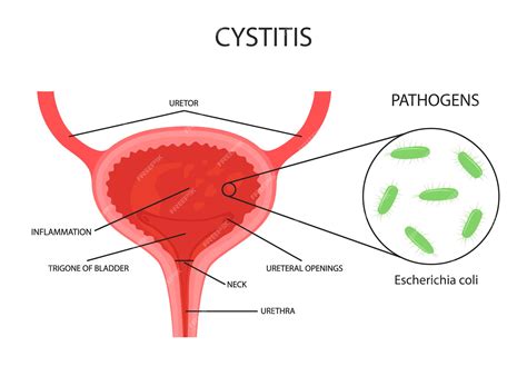 Premium Vector Vector Illustration Of The Bladder Cystitis