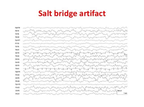 Eeg Artifacts