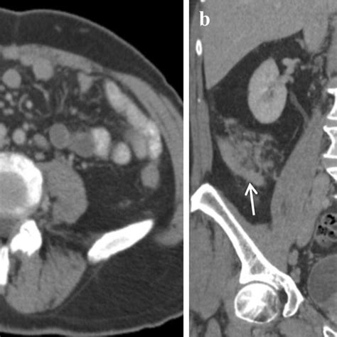 Axial A And Coronal B Contrast Enhanced CT Images Show A Diffusely Download Scientific