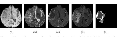 Figure 1 From Multimodal Brain Tumor Image Segmentation Based On 3d