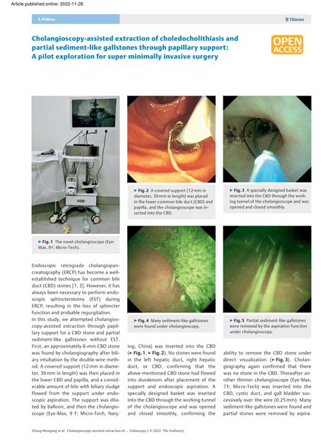PDF Cholangioscopy Assisted Extraction Of Choledocholithiasis And Partial Sediment Like