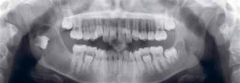 Orthodontic Update Options To Preserve Teeth Displaced By Dental Cysts